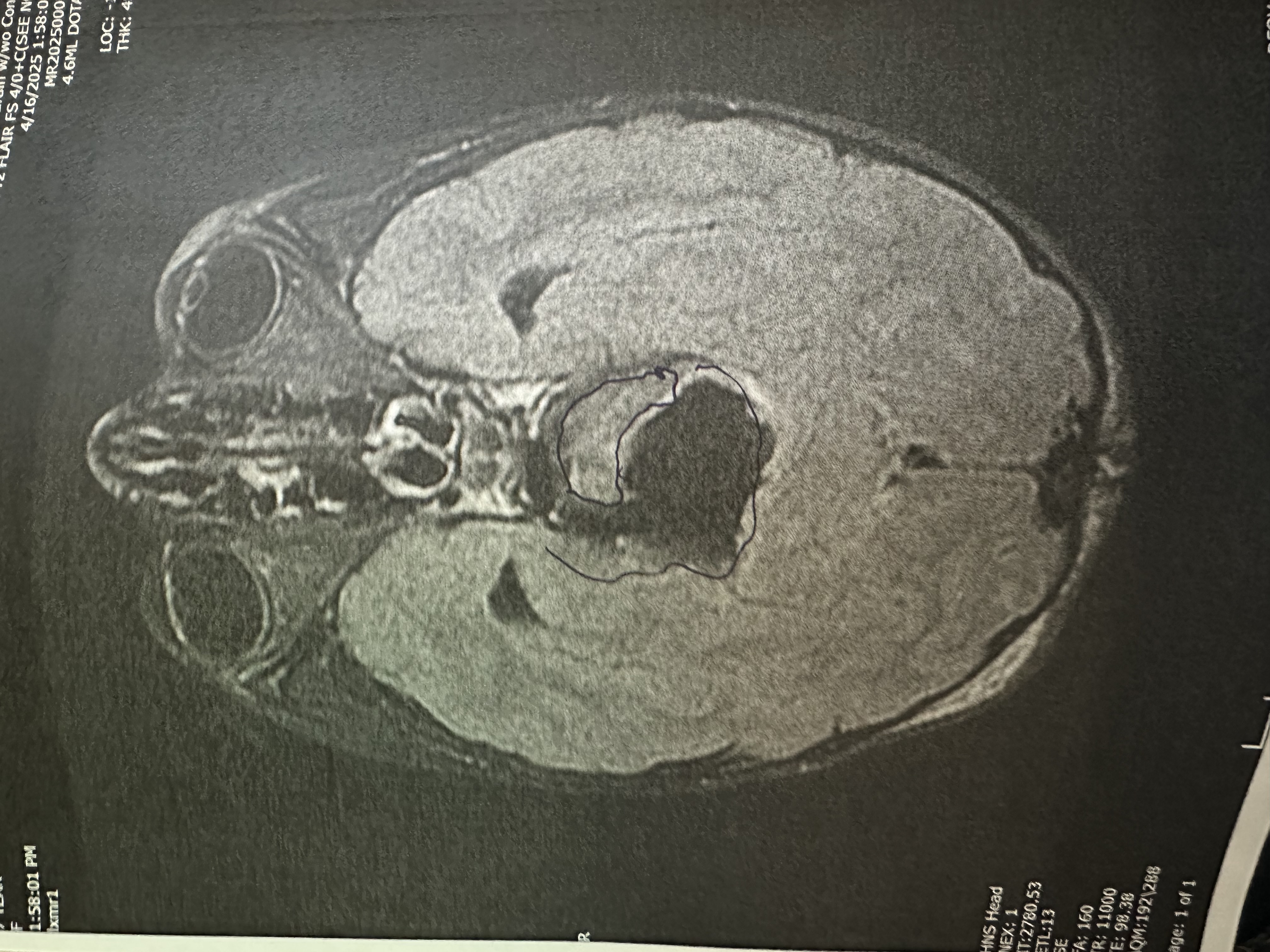 Fund the First | Abigail’s Brain Tumor Recovery Fund